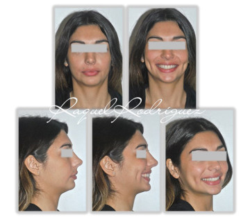 Fotografía como elemento diagnóstico en Ortodoncia – Estética Dental ...